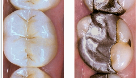 Blog Welcome and Silver Mercury Fillings | Tooth Colored Restorations ...