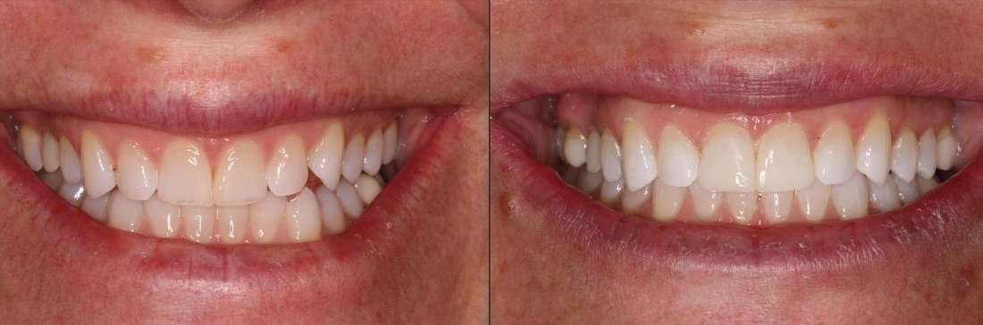 CLEAR ALIGNER BRACES: ESTHETIC AND LONGEVITY CHANGERS FOR TEETH AND THE ...